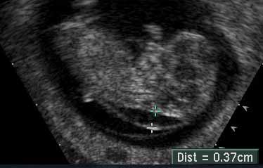 UKB | Ultraschalldiagnostik (Sonographie)