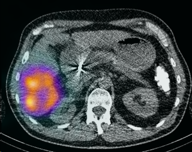 UKB | Selective Internal Radiotherapy (SIRT) of hepatic malignancies ...